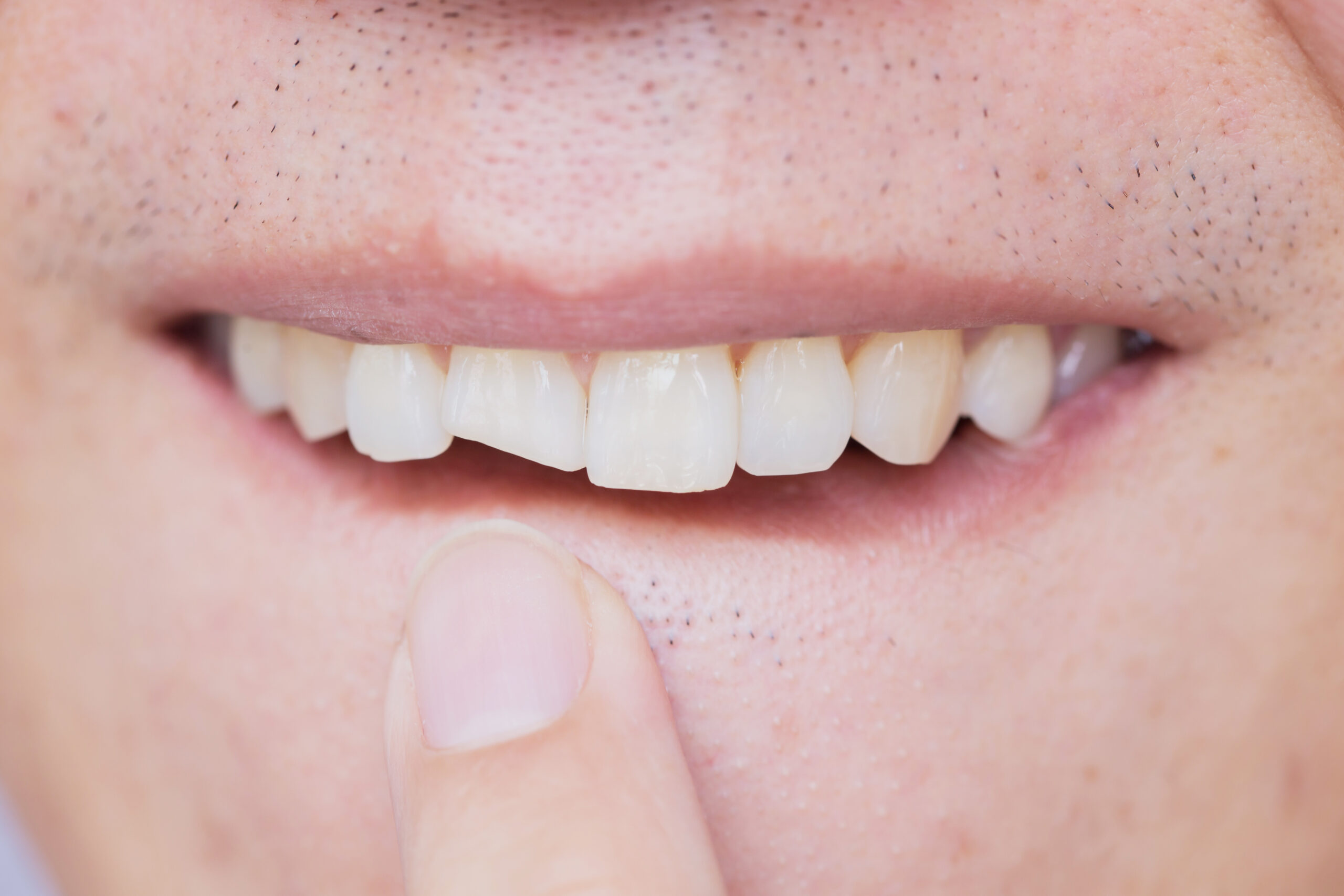 Chipped Tooth & Broken Tooth Repair in Taylor - Taylor Made Dental