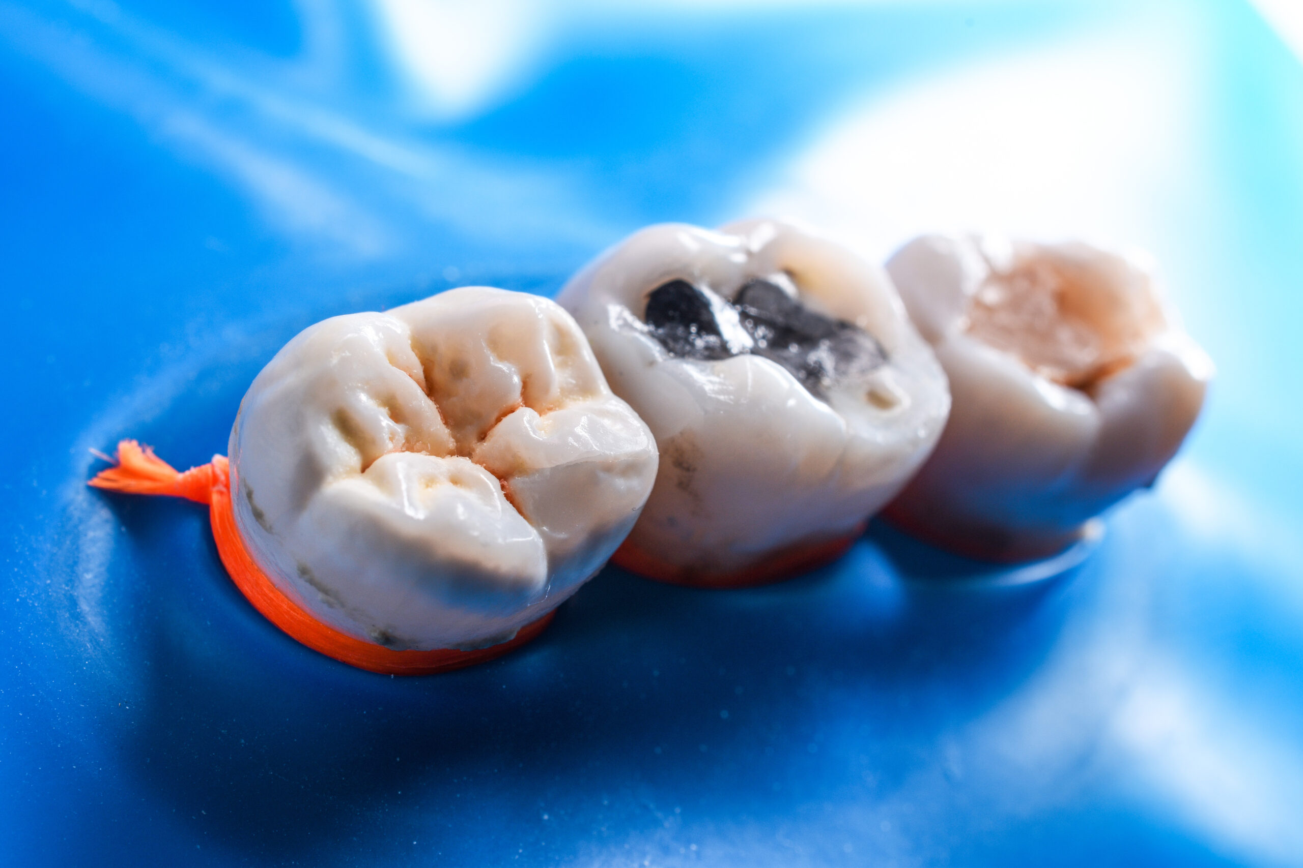 Fillings in Taylor - Taylor Made Dental