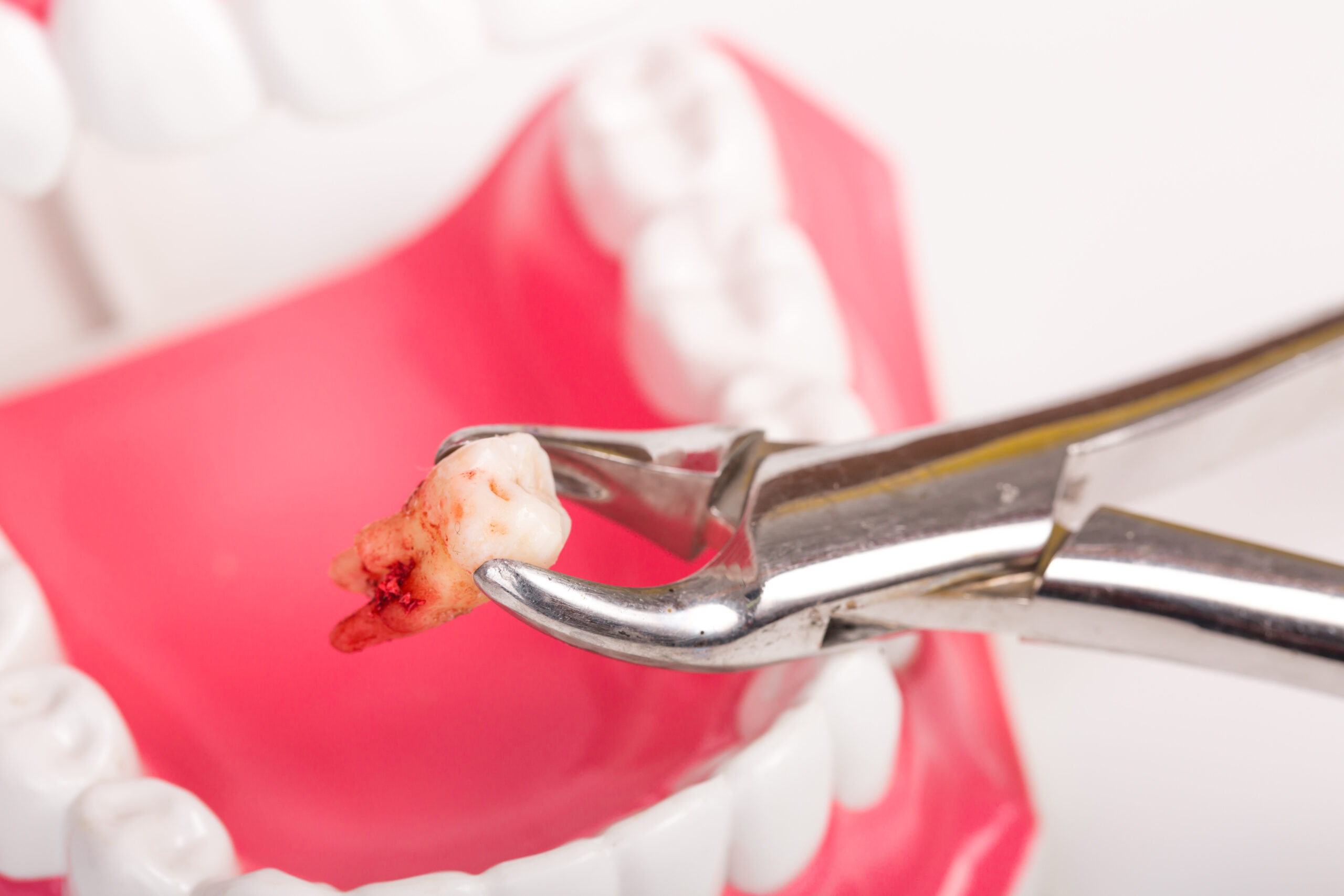 Cavities and Tooth Decay Treatment in Taylor - Taylor Made Dental